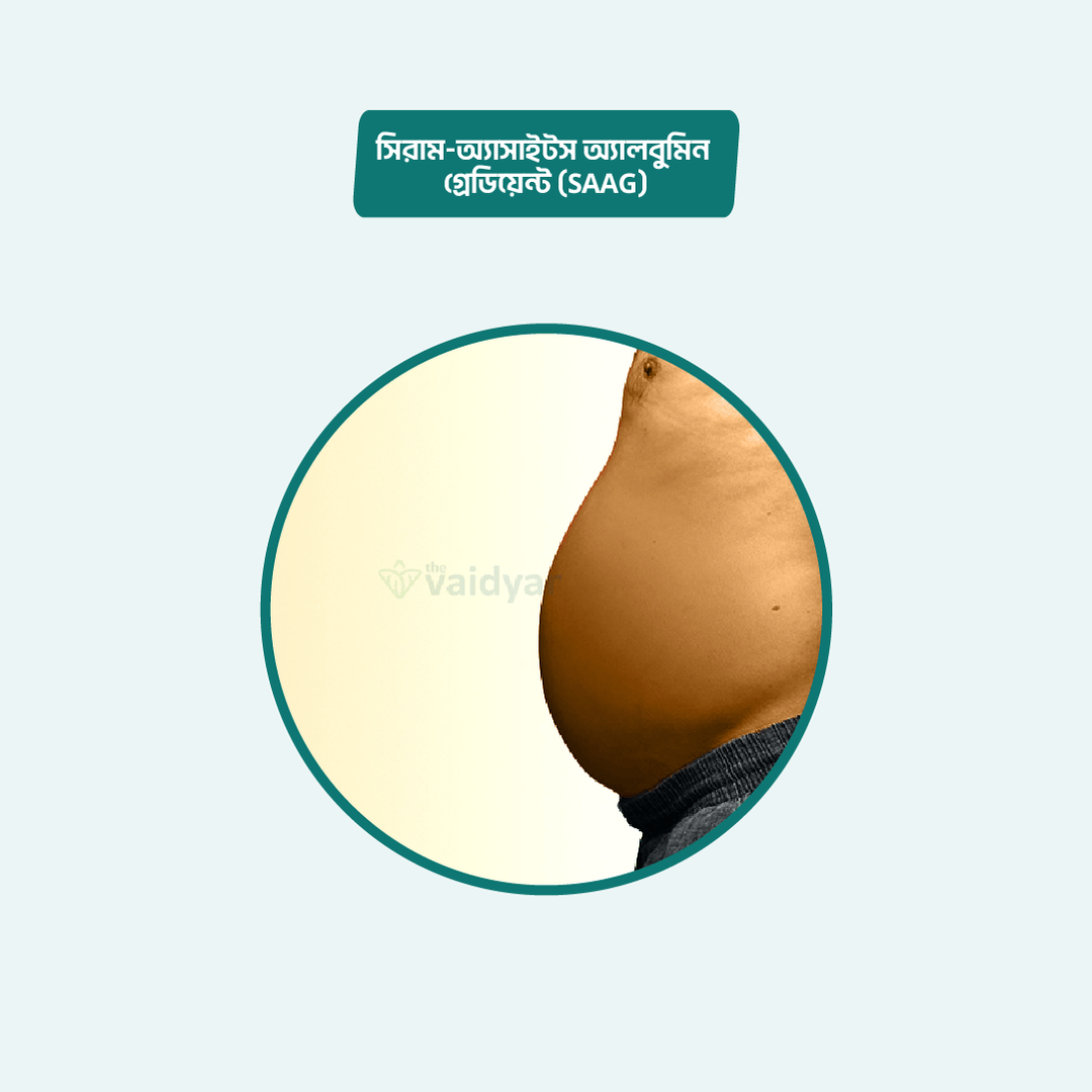 Serum-ascites albumin gradient(SAAG) - Arogga Online Lab